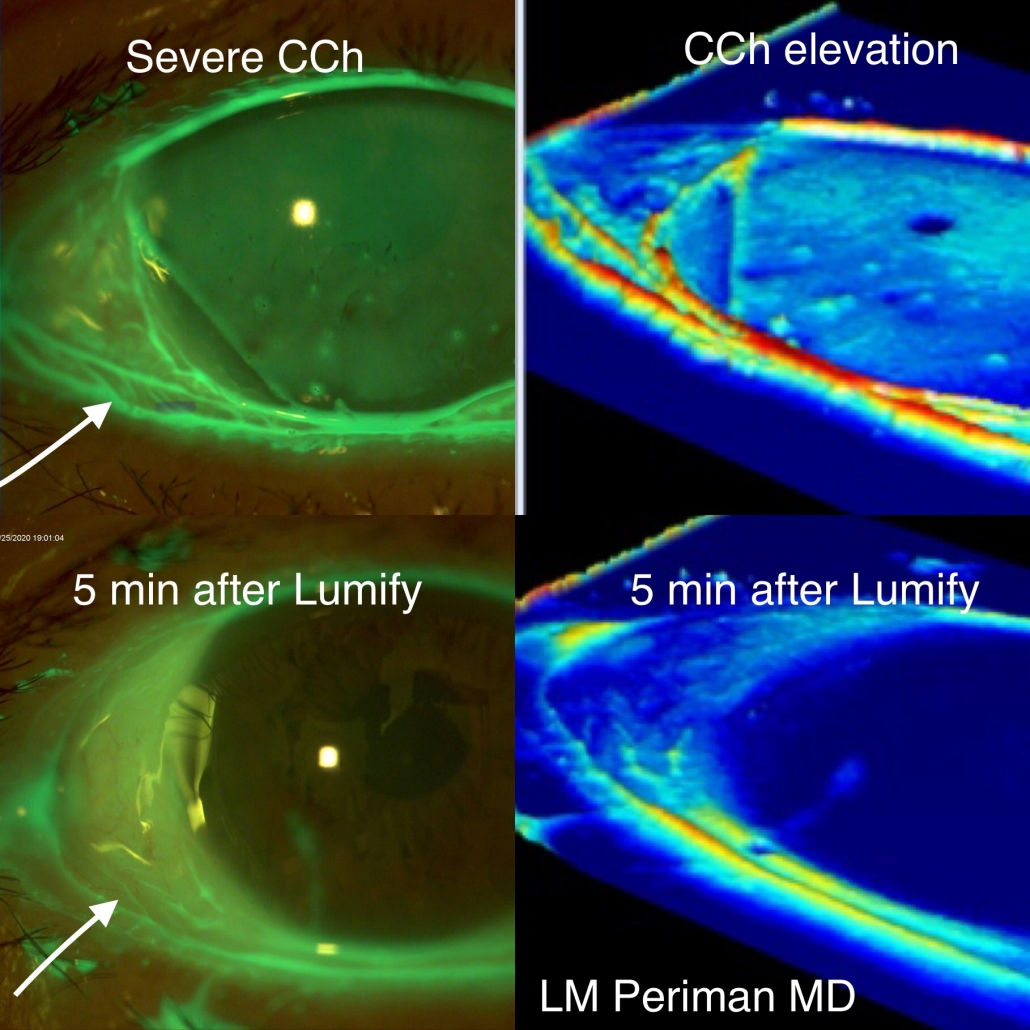 Conjunctivochalasis - Dry Eye Master