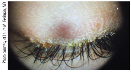 crusty-eyelashes - Dry Eye Master