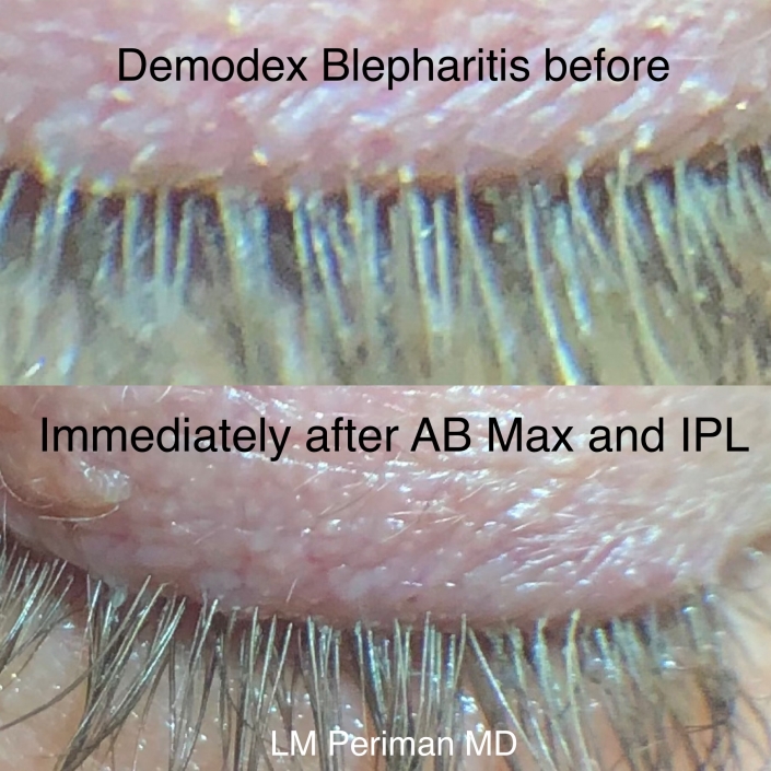 demodex-bleph-abmax-ipl - Dry Eye Master