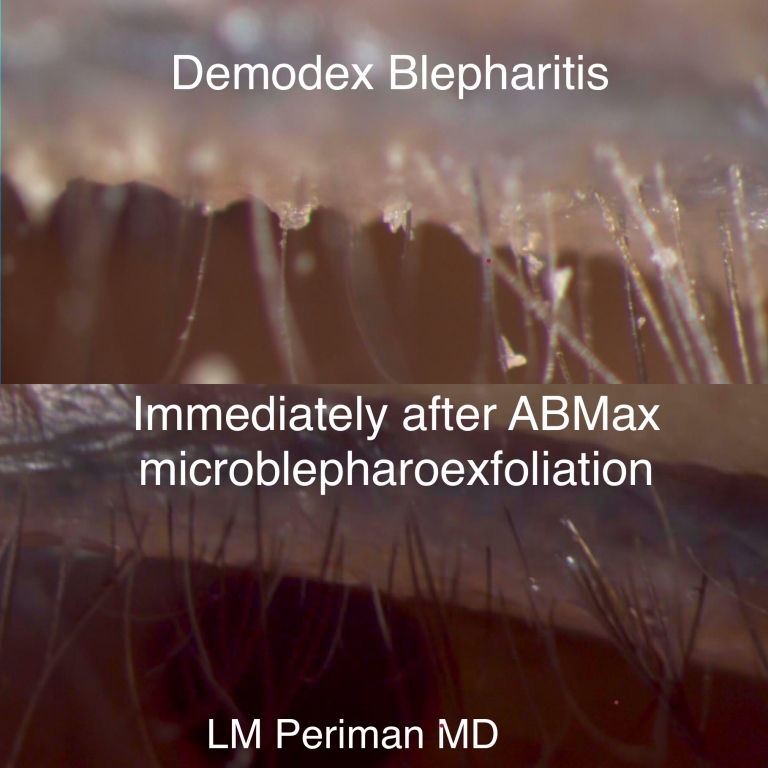 demodex-blepharitis - Dry Eye Master