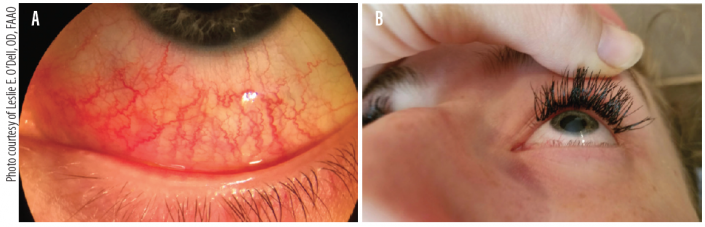 Cosmetic Use and Dry Eye