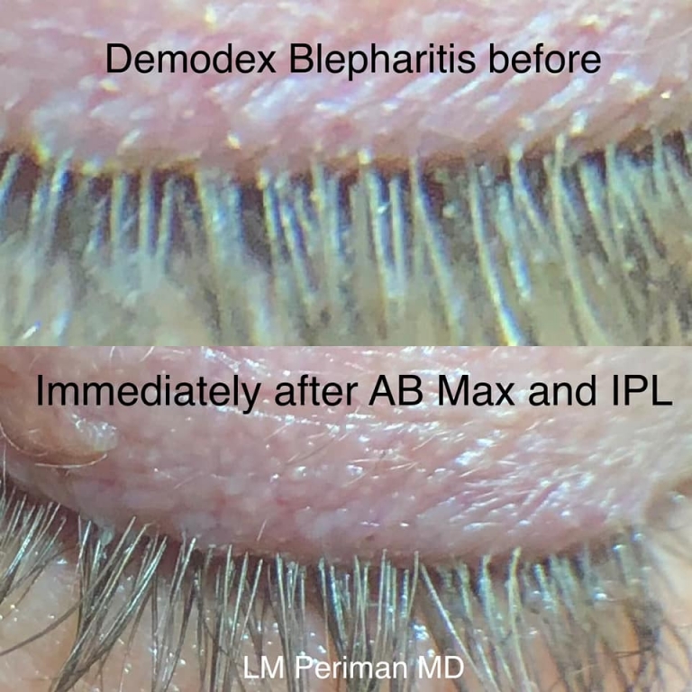 SPK Gallery - Dry Eye Master