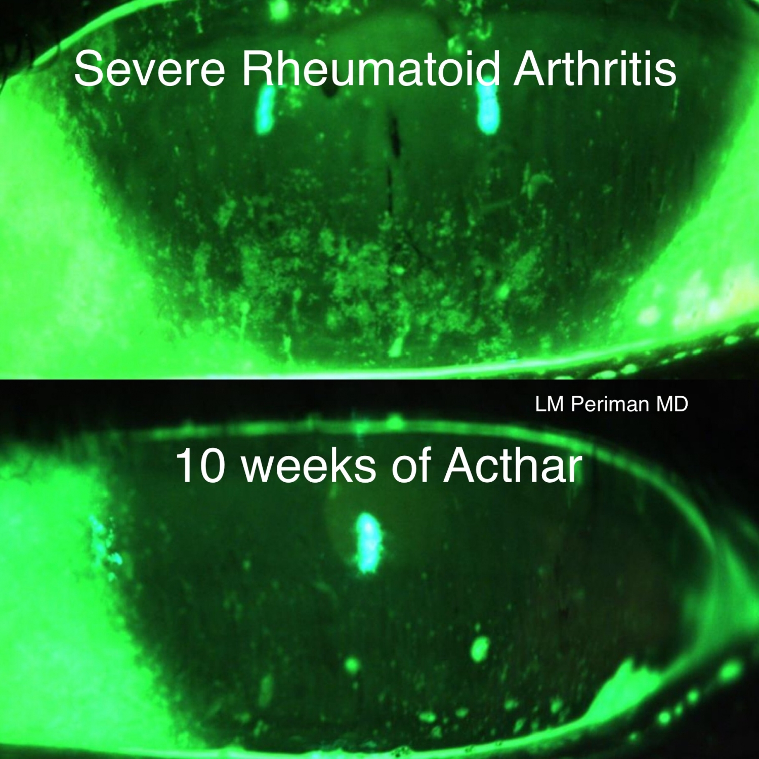Rheumatoid Arthritis Bloodshot Eyes at Paul Pineda blog