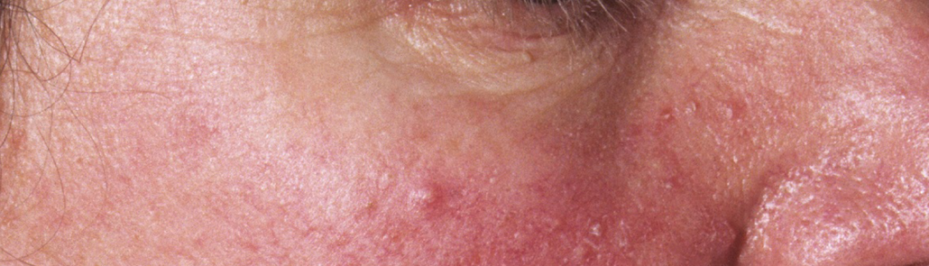 Rosacea, MGD, Dry Eye Treatments: Ophthalmologist Laura Periman, MD