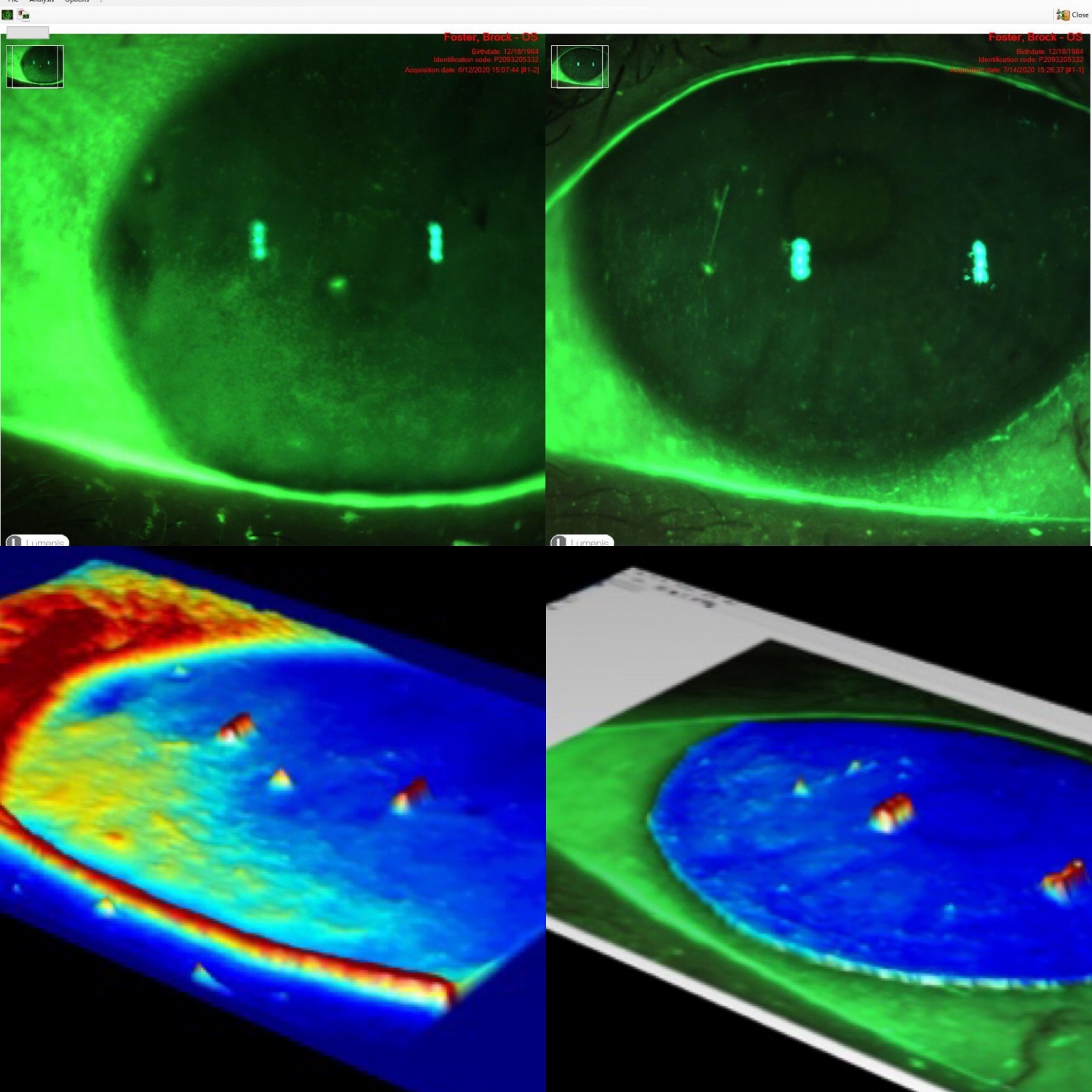 spk-topo - Dry Eye Master